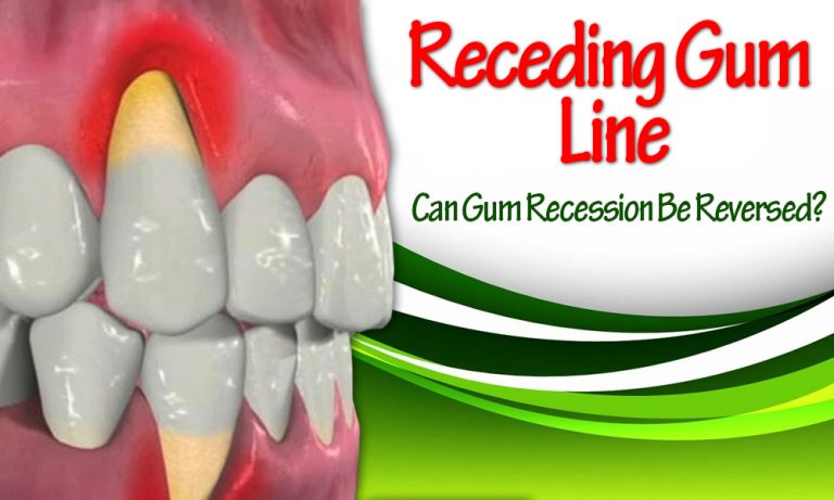 Gum Recession Facts And Advice - OraMD Blog