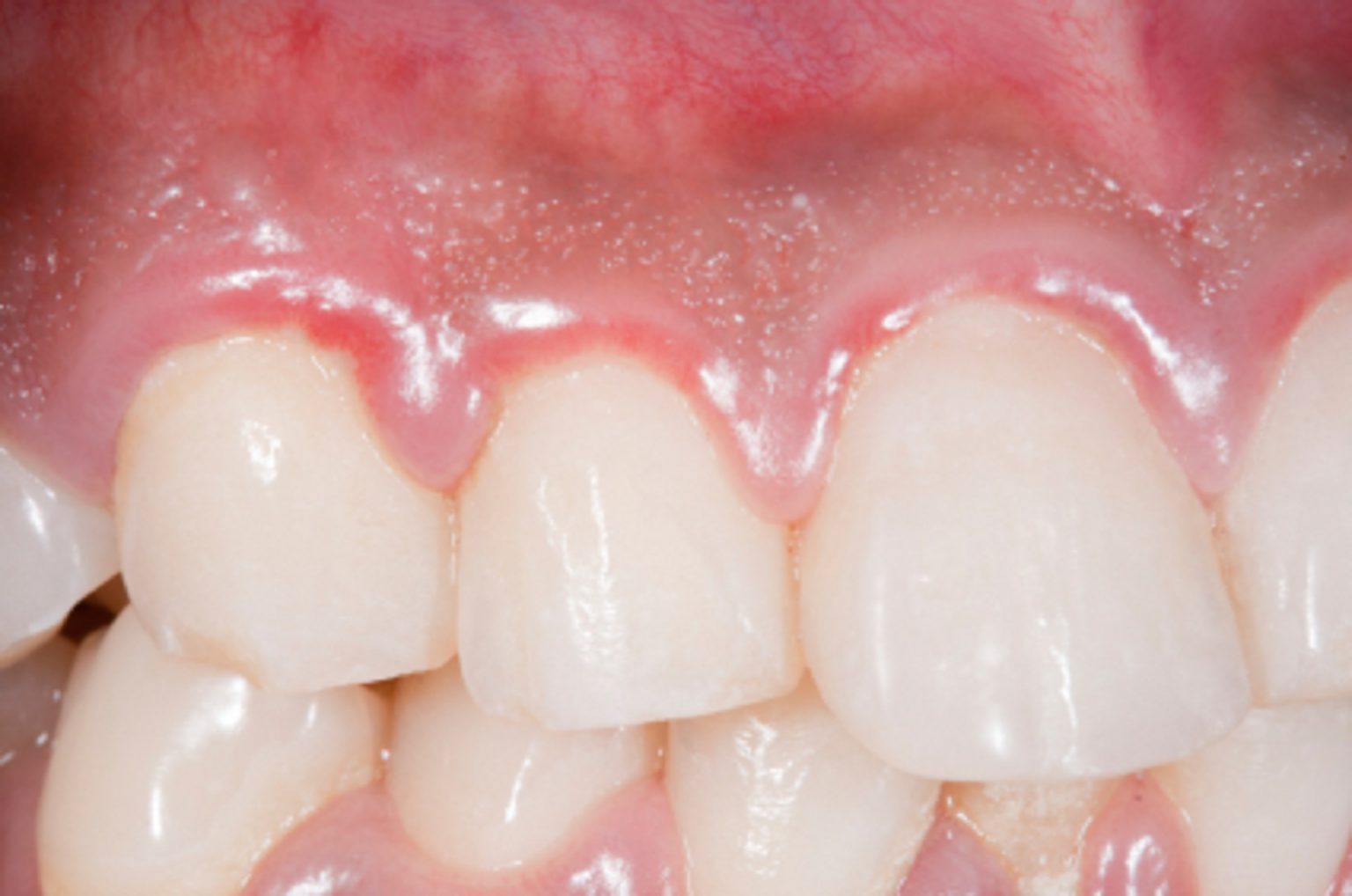Bright & Dark Red Gums: Its Causes And Treatment | OraMD